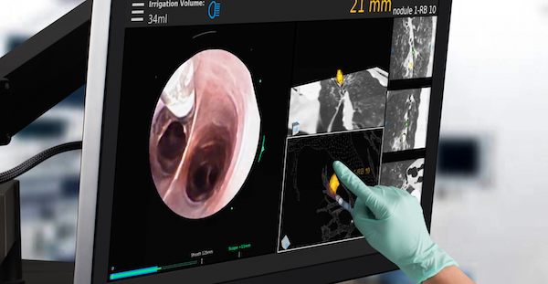 Earlier Lung Cancer Detection at TMH Saves Lives | Tallahassee Memorial ...